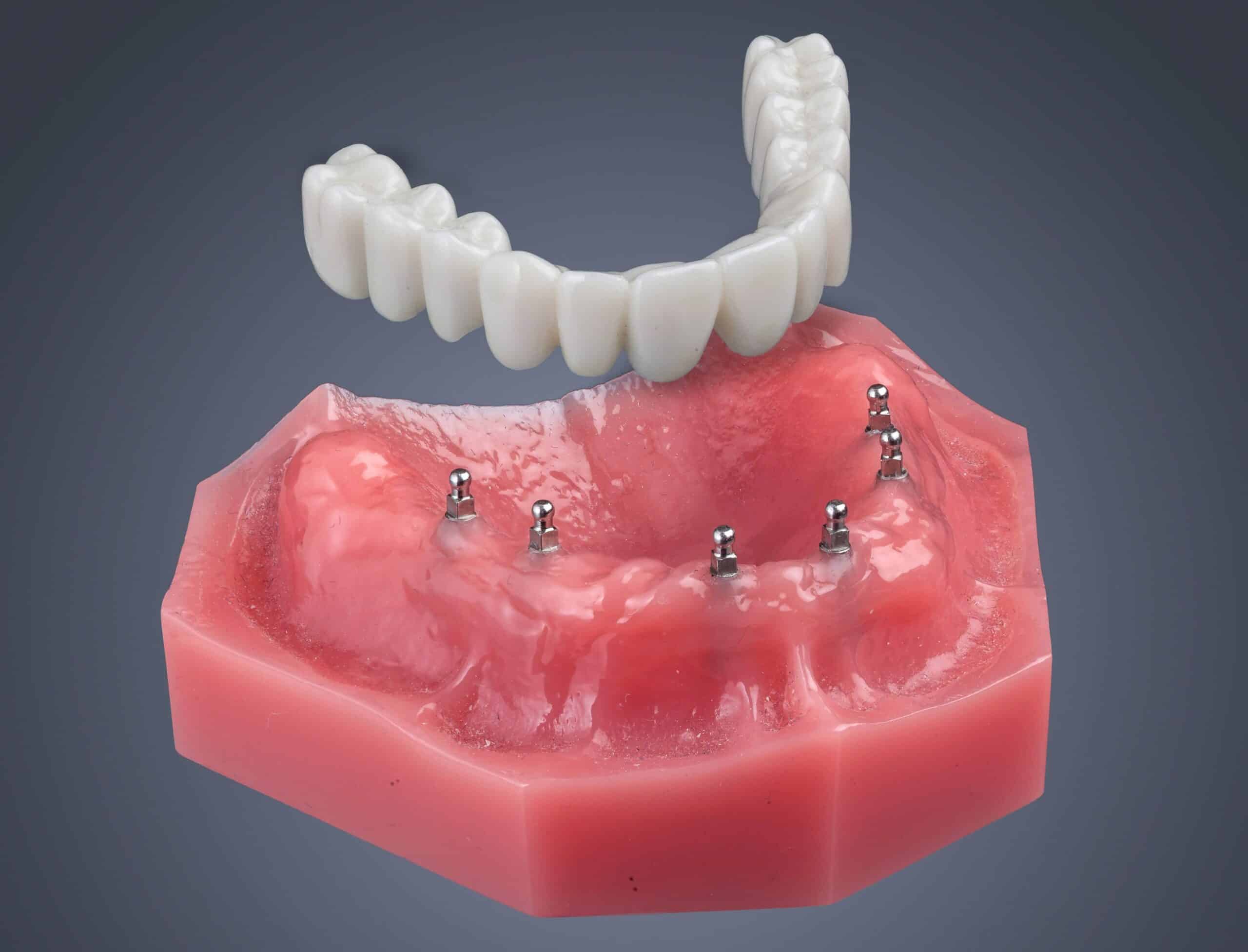 Fix on Six Dental Implants | Mini Dental Implant Centers of America